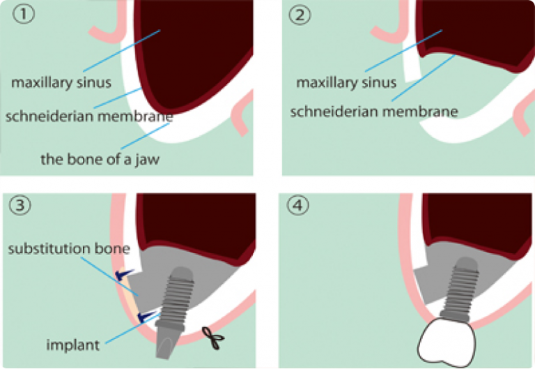 Dr. Steven Tsoung | Sinus Lift (Sinus Augmentation)